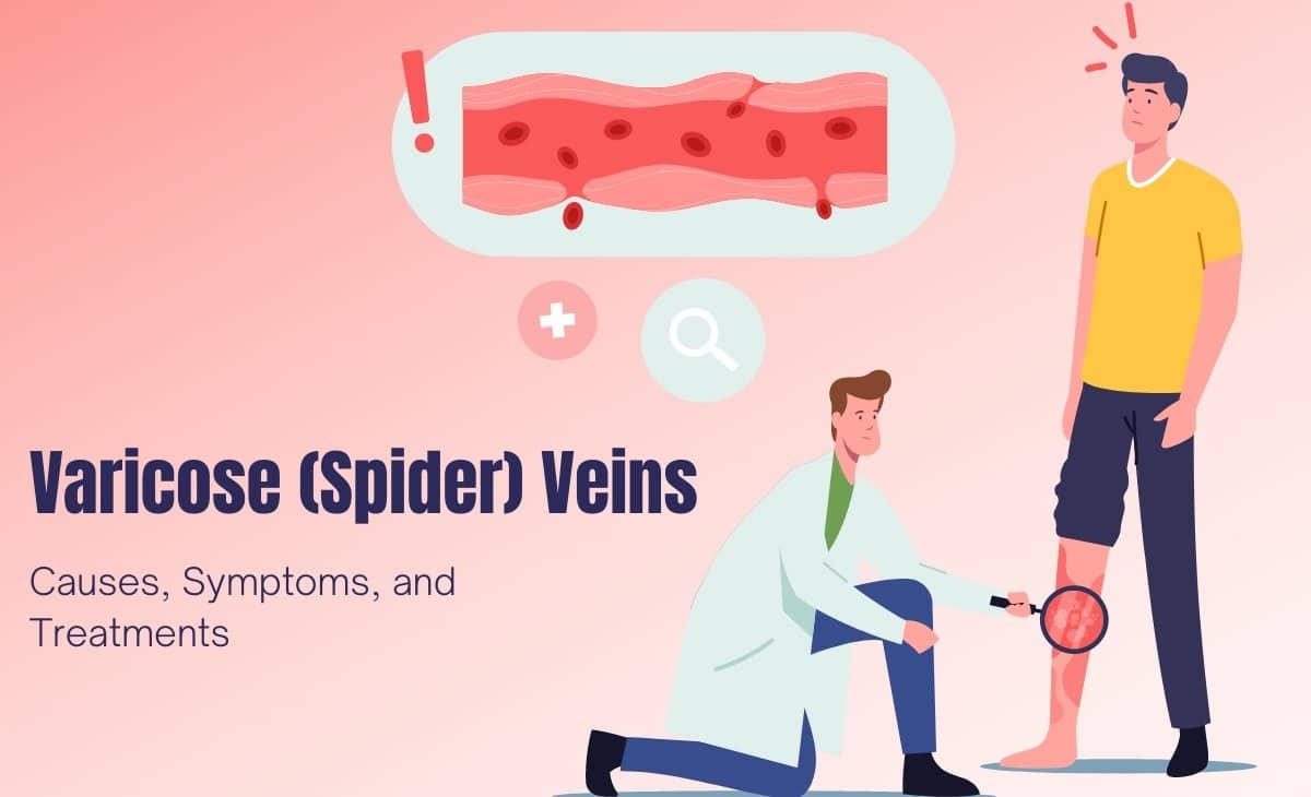 Varicose (Spider) Veins: Causes, Symptoms, and Treatments - Resurchify