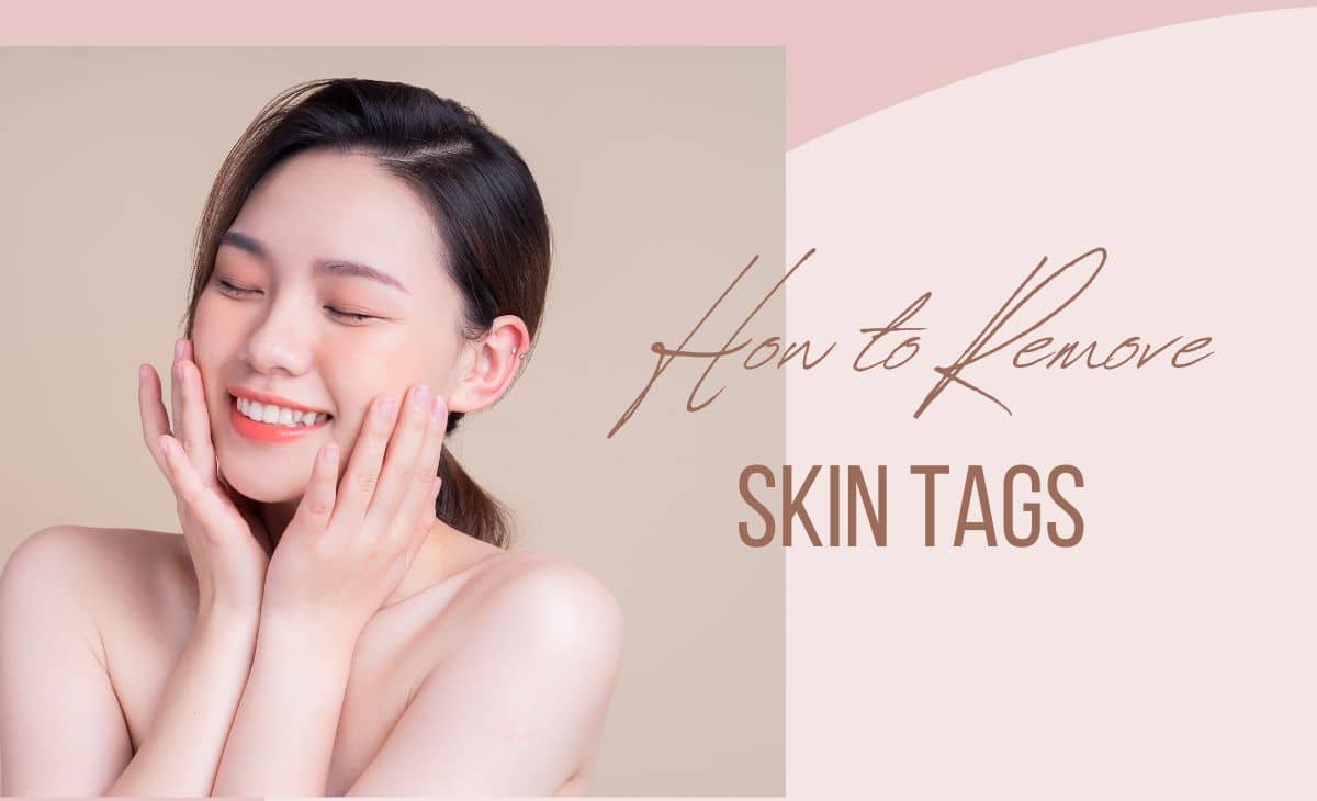 How To Remove Skin Tags Causes And More Resurchify