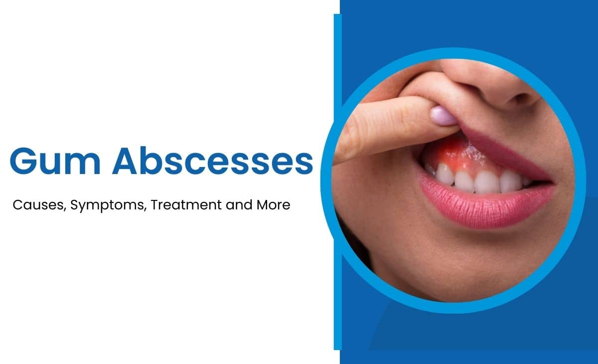 Gum Abscesses Causes Symptoms Treatment And More Resurchify